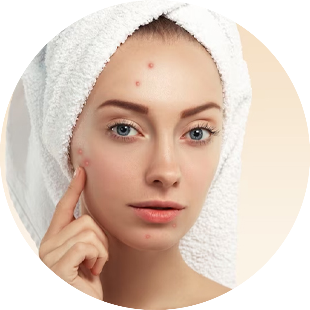 Acne Care Range| Herbal Solution for clear skin – Brawn Herbal